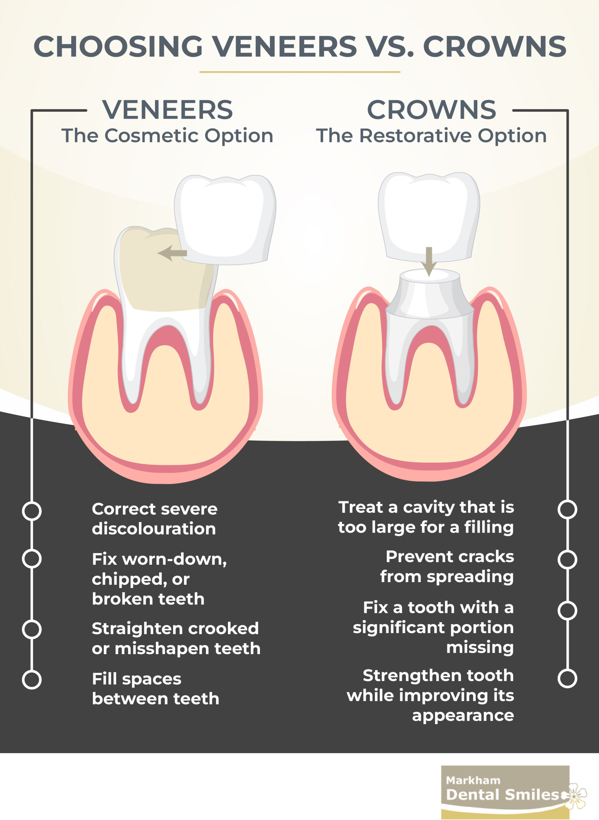 Veneers vs. Crowns: When to Use Which | Unionville